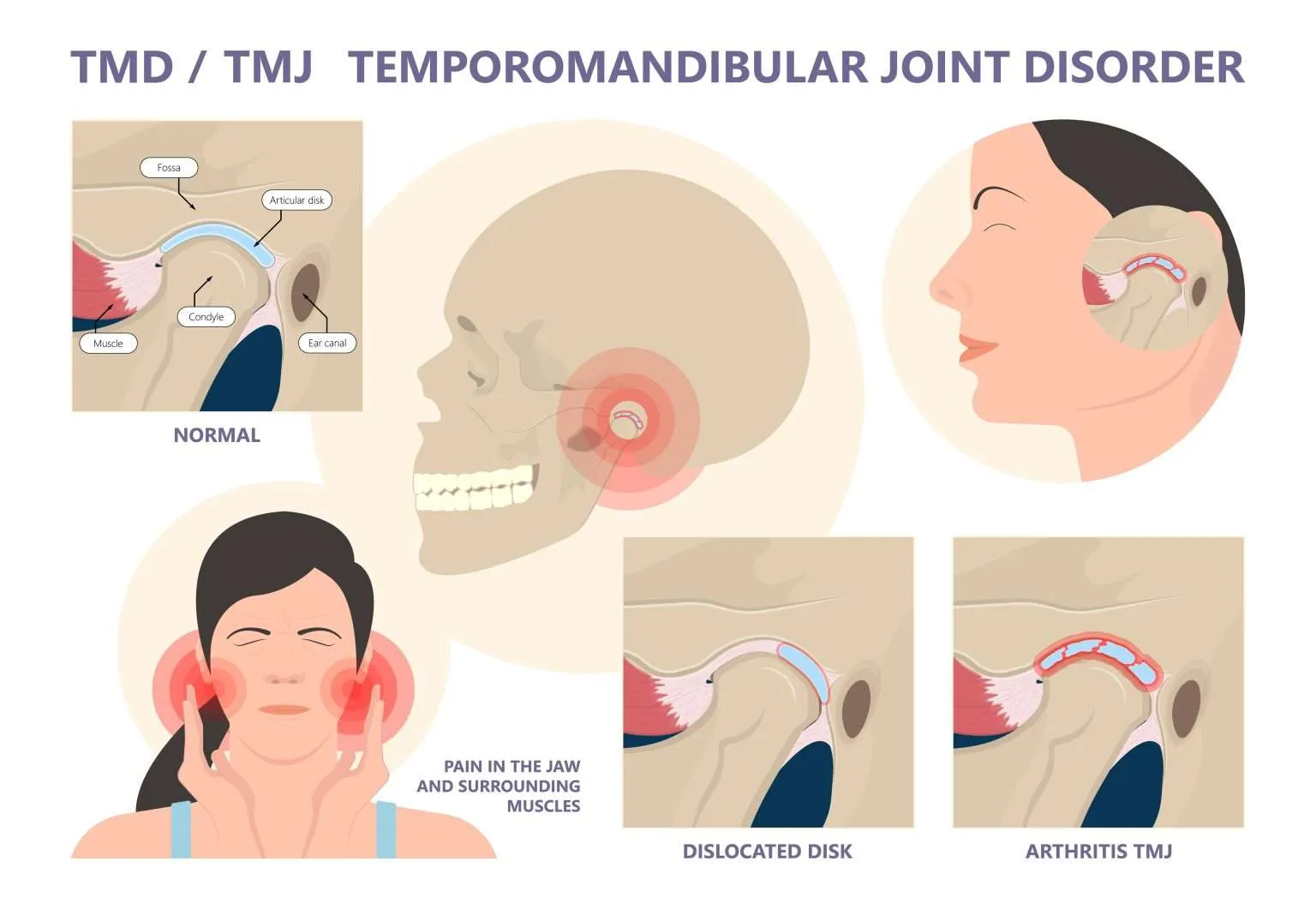 Temporomandibular Joint Dysfunction Self-Care: Physio Exercises & Home ...