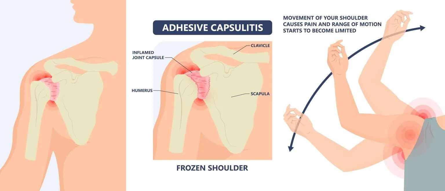 Frozen Shoulder Exercises: At-Home Relief & Lasting Physio Treatments ...